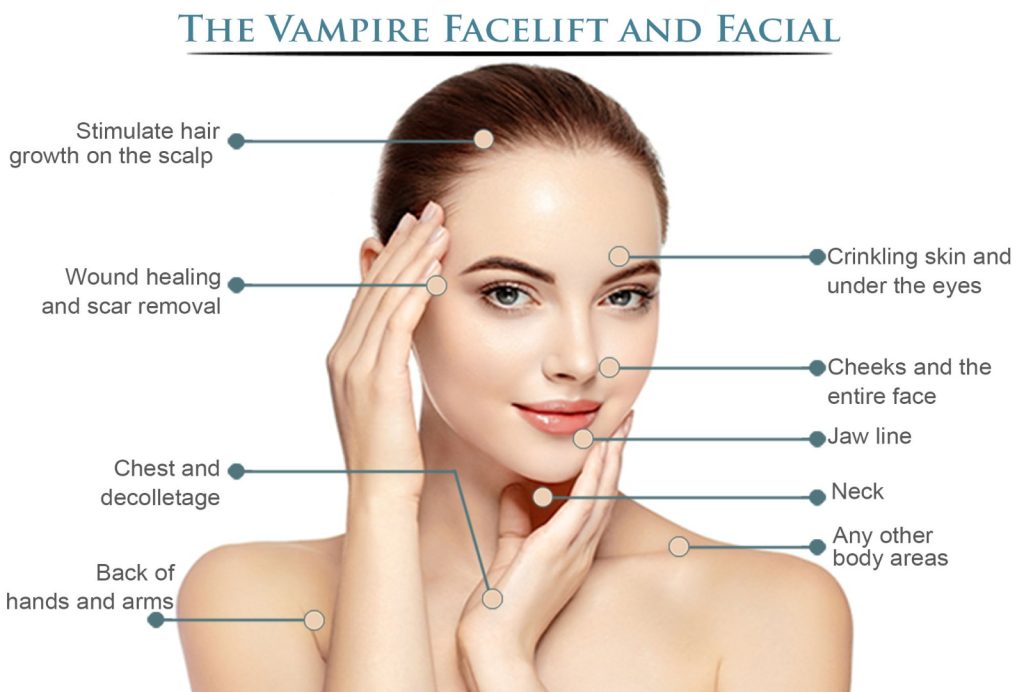Vampire Lift Treatment - Vernon Skin and Hair Clinic